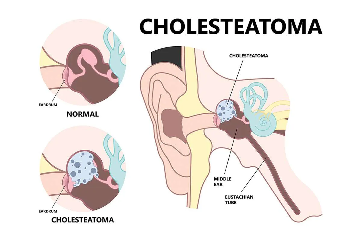 Cholesteatoma Doctor Philadelphia Berger Henry ENT Cholesteatoma Doctor Philadelphia Berger Henry ENT